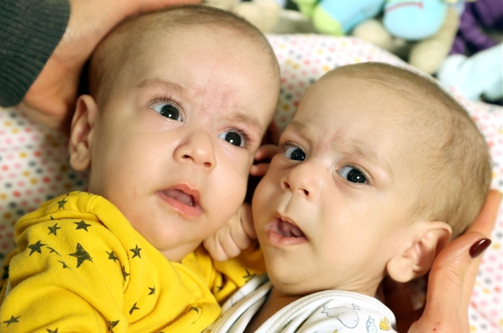 Conjoined Twin Babies